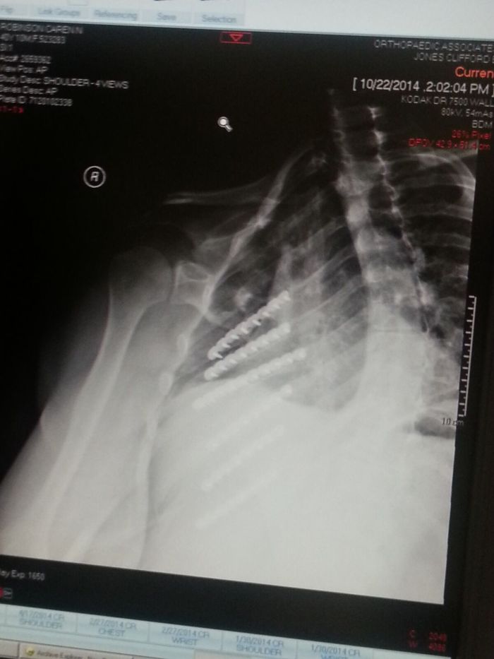 Flail Chest and Rib Plating | HOPE TBI