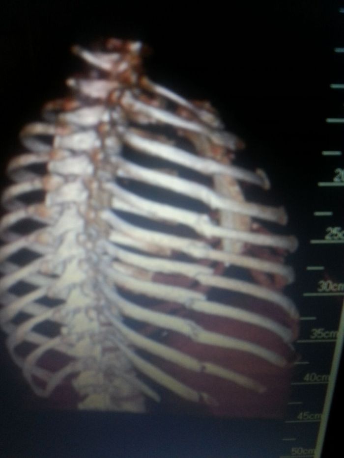 Flail Chest and Rib Plating | HOPE TBI