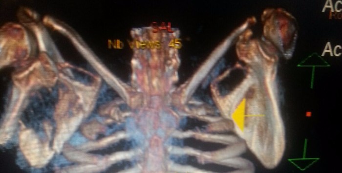 Flail Chest and Rib Plating | HOPE TBI