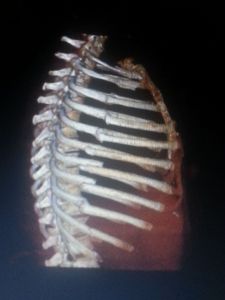 Flail Chest and Rib Plating | HOPE TBI