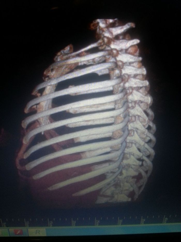 Flail Chest and Rib Plating | HOPE TBI