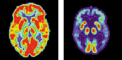 PET Scan | HOPE TBI